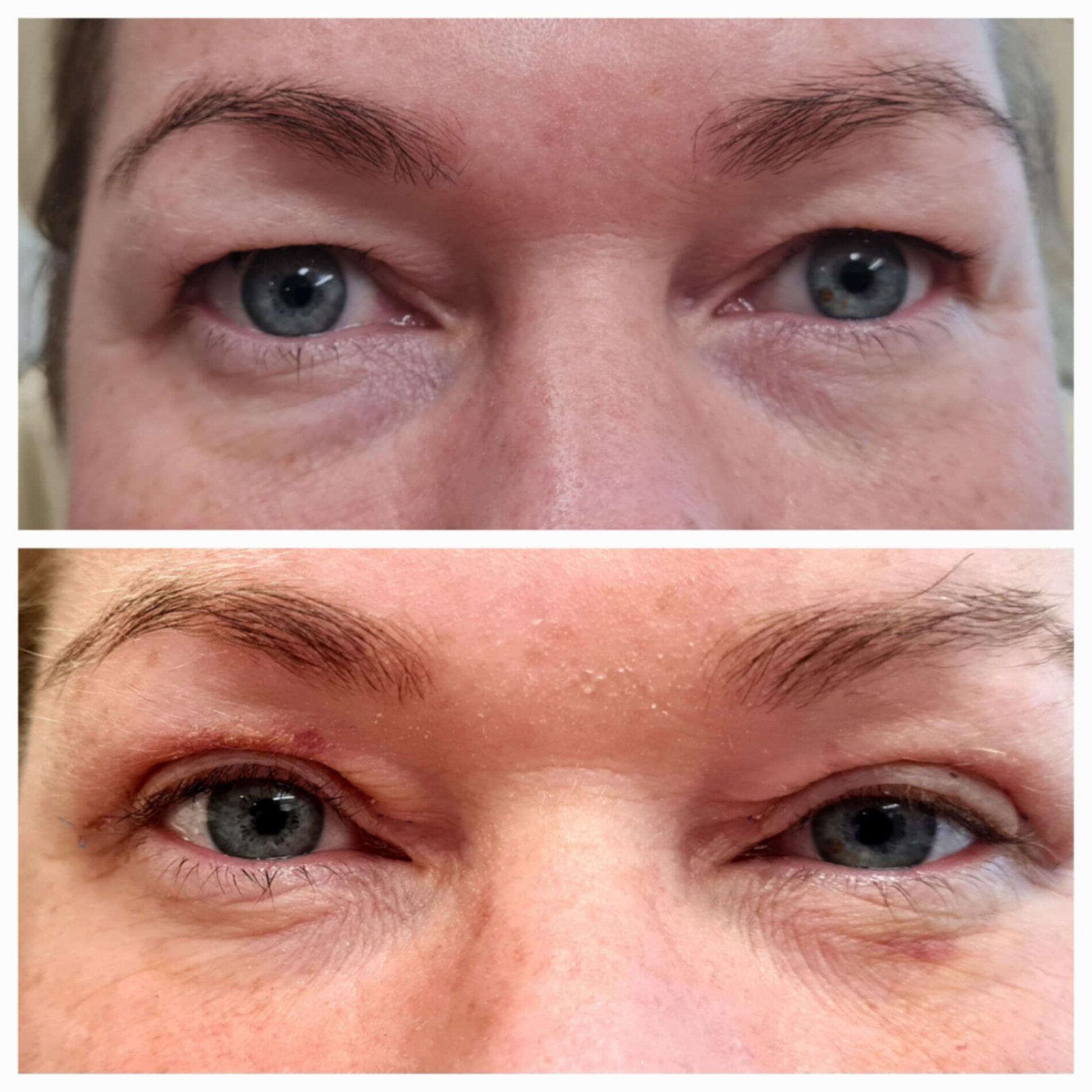 Silma ülalaugude blefaroplastika • Turman Silmakliinik